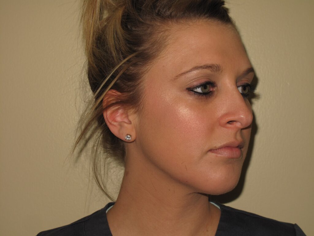 Bellafill Long Lasting Dermal Filler | Dermal Filler Treatment | SLL
