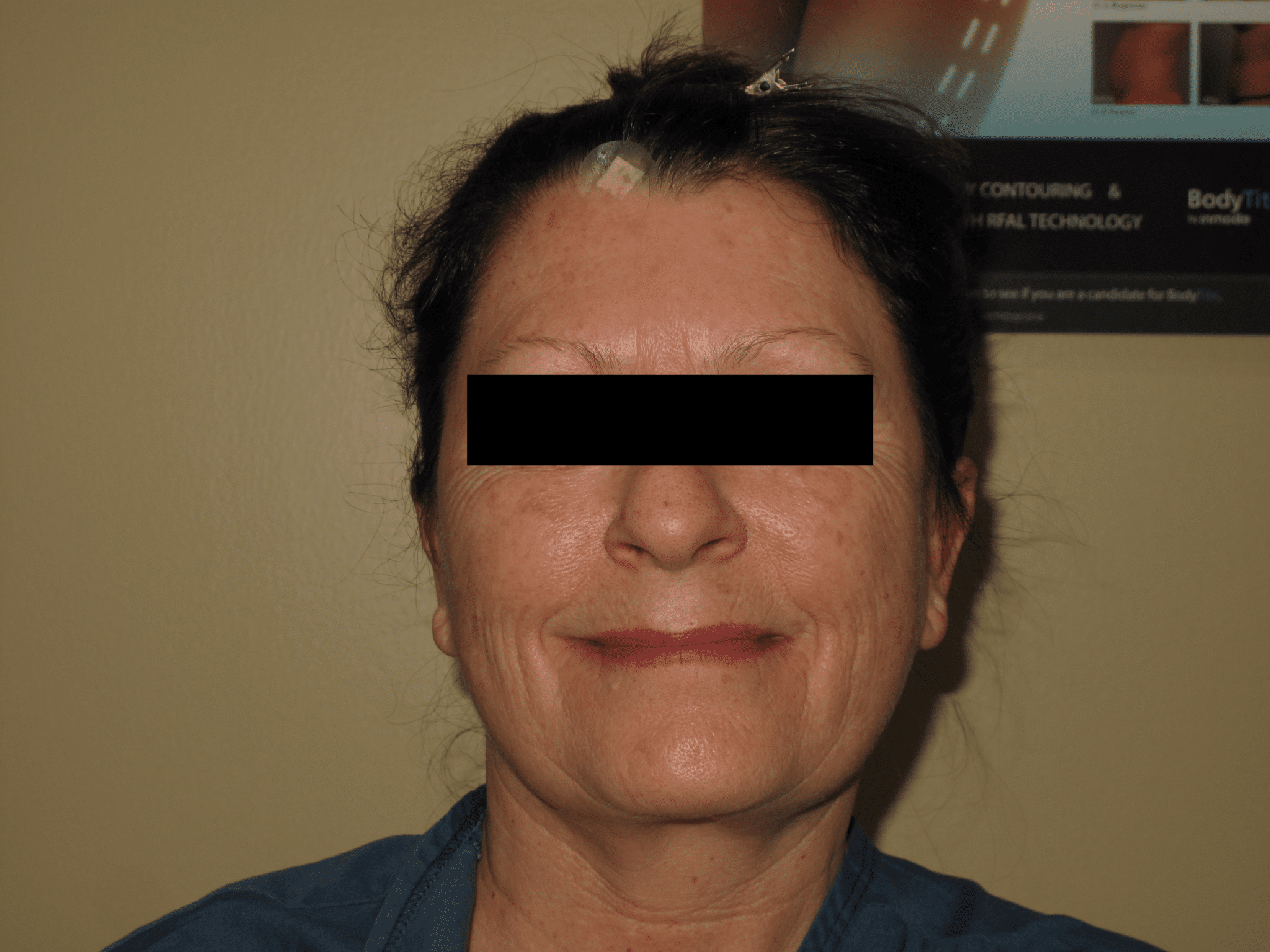 Fat Grafting and Transfer Liposuction | St Louis Lipo Center