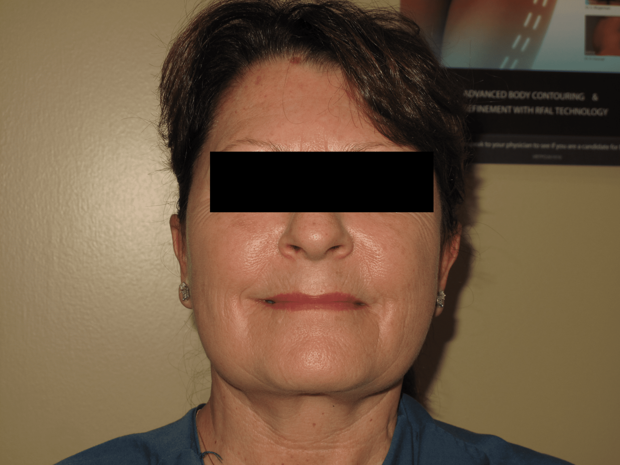 Fat Grafting and Transfer Liposuction | St Louis Lipo Center