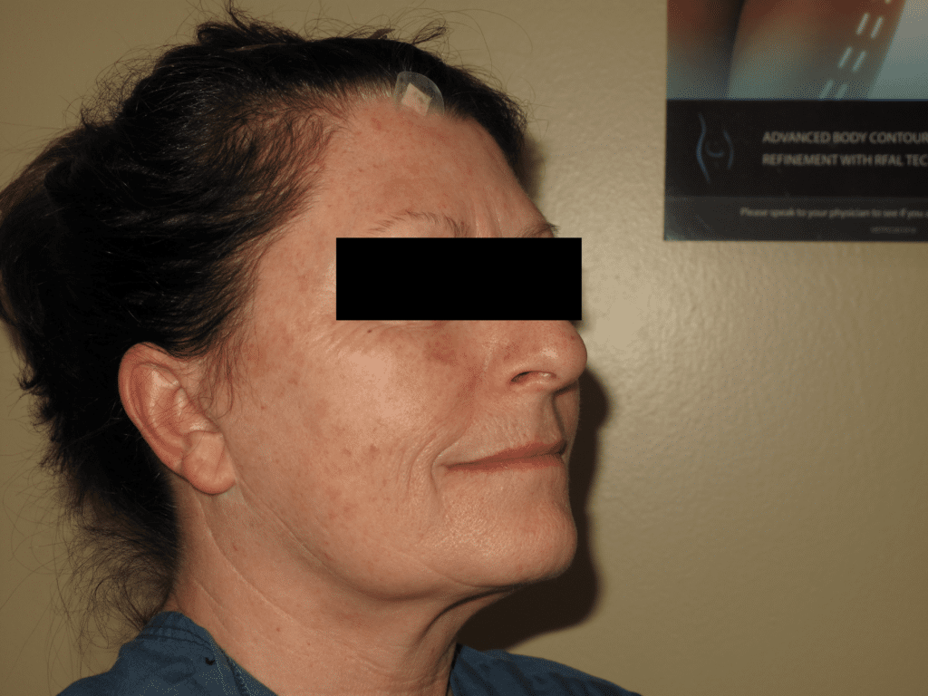 Fat Grafting and Transfer Liposuction | St Louis Lipo Center