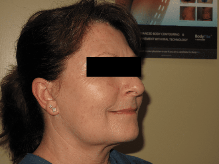 Fat Grafting and Transfer Liposuction | St Louis Lipo Center