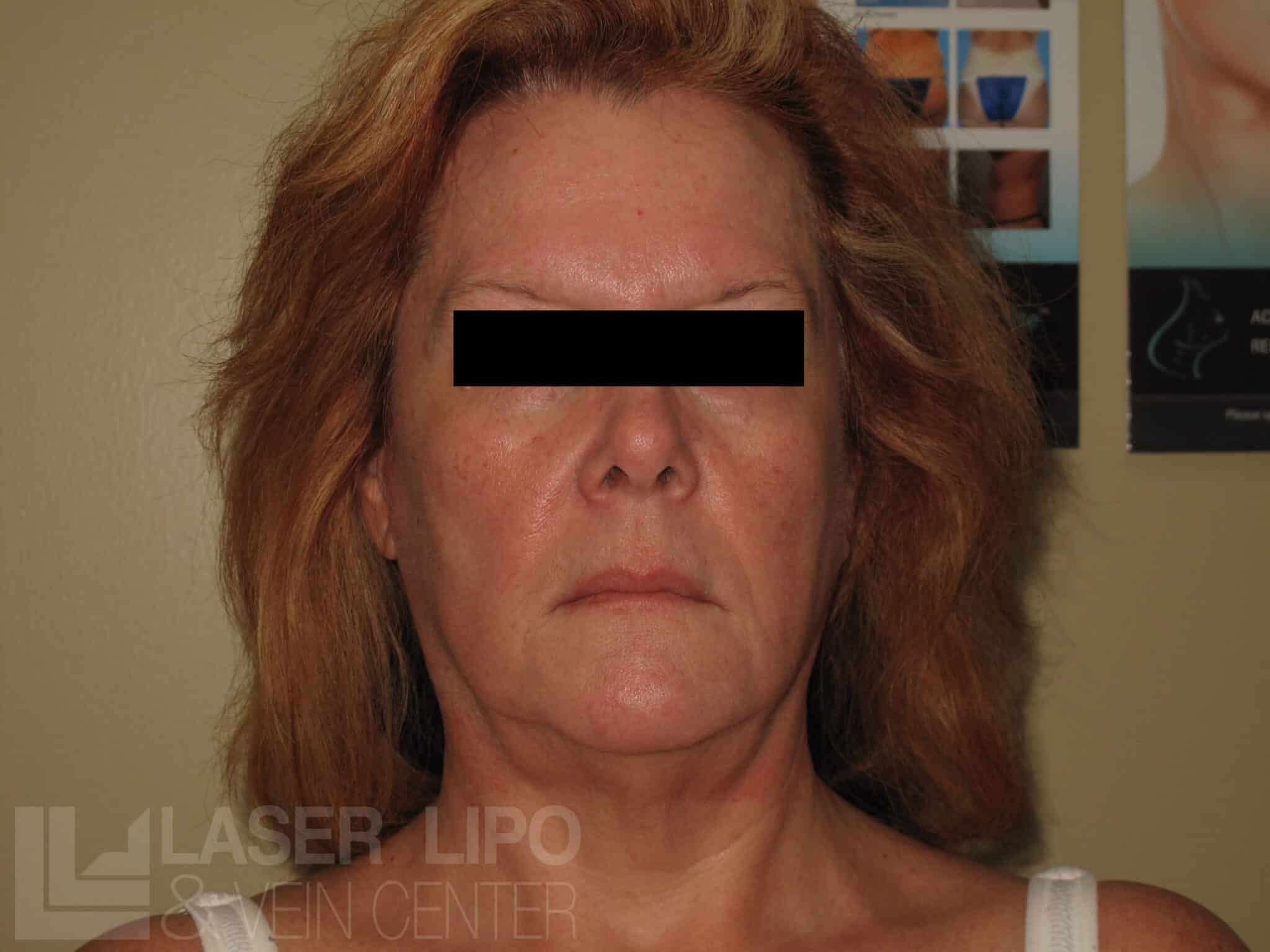 Fat Grafting and Transfer Liposuction | St Louis Lipo Center
