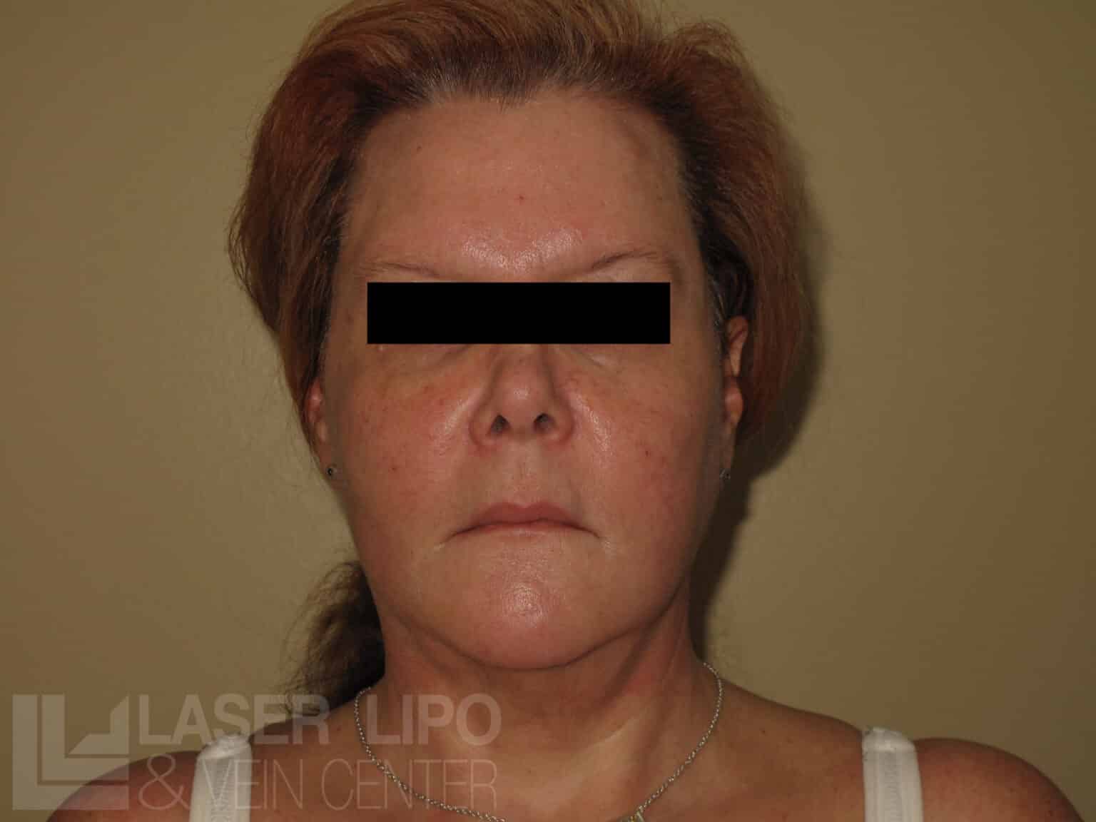 Fat Grafting and Transfer Liposuction | St Louis Lipo Center