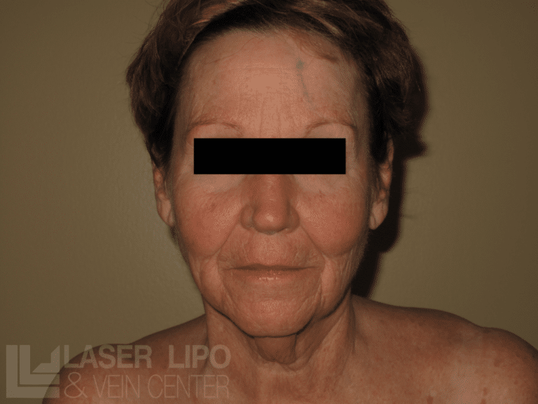 Fat Grafting and Transfer Liposuction | St Louis Lipo Center