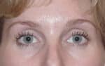 Cosmetic Botox in St Louis | St. Louis Liposuction Center
