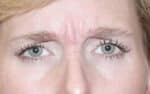Cosmetic Botox in St Louis | St. Louis Liposuction Center