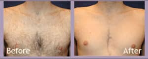 Before And After Laser Hair Removal St Louis Cosmetic Surgery Center